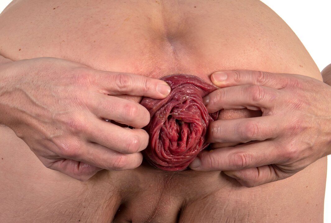 Prolapso - botão de rosa | xHamster