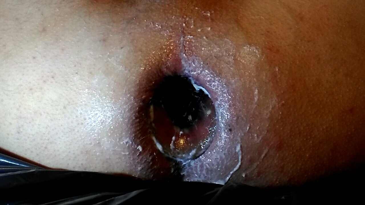 Dilatacion Anal Xhamster 2311