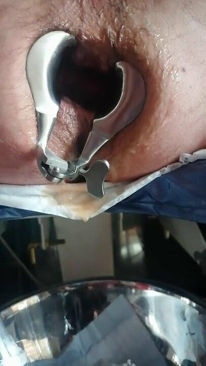 Anal Dehnung | xHamster